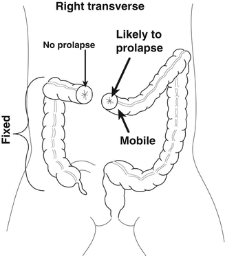 Colostomy | SpringerLink