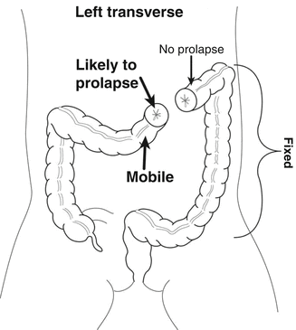 Colostomy | SpringerLink