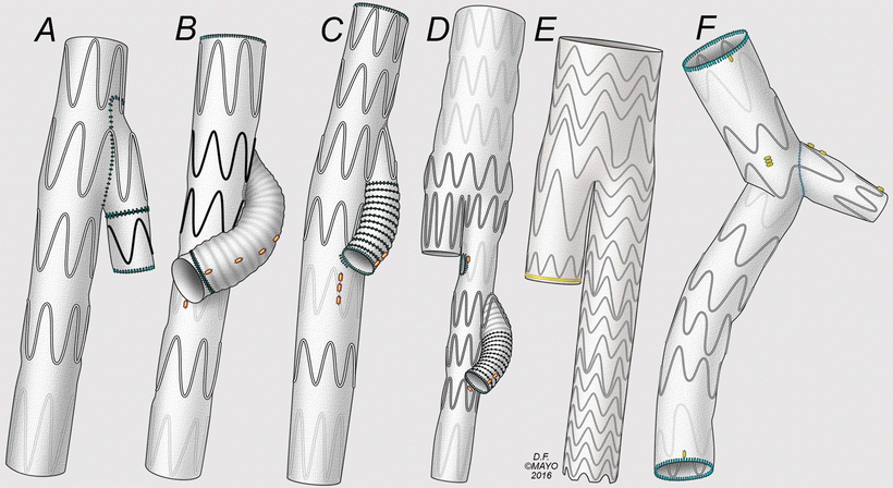 Managing Endovascular Inventory | SpringerLink