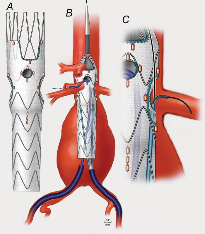 Current Device Designs to Incorporate Visceral Arteries | SpringerLink