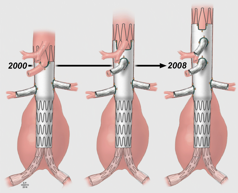 Sizing and Planning Fenestrated and Multibranched Endovascular Repair ...