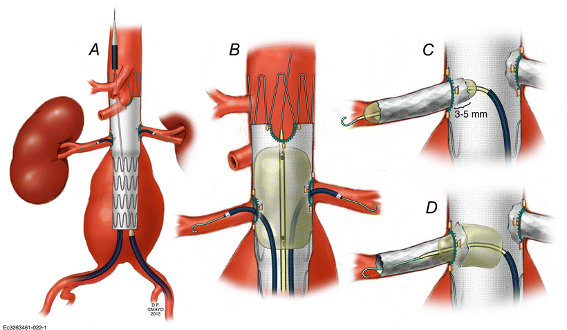 Techniques of Implantation of Fenestrated and Multibranched Stent ...