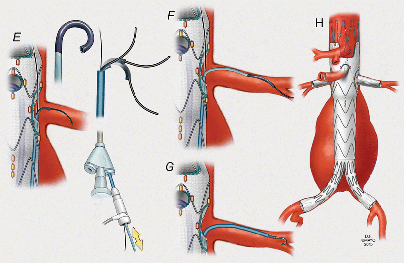 Techniques of Implantation of Fenestrated and Multibranched Stent ...
