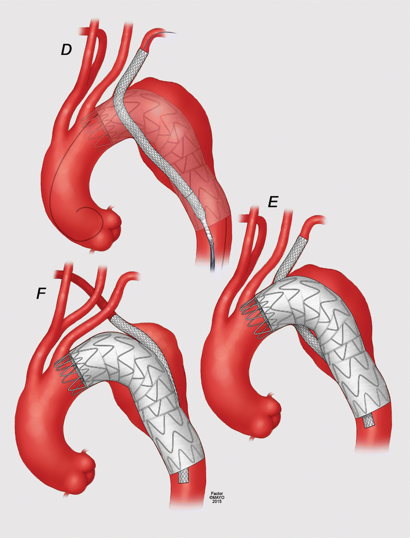 Parallel Stent Graft Techniques to Facilitate Endovascular Repair in ...