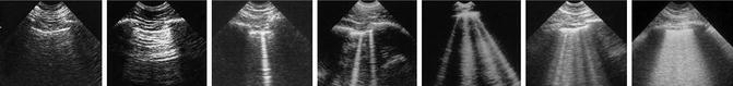 Lung Rockets: The Ultrasound Sign of Interstitial Syndrome | SpringerLink
