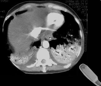 PLAPS and Lung Consolidation (Usually Alveolar Syndrome) and the C ...