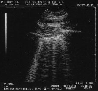 PLAPS and Lung Consolidation (Usually Alveolar Syndrome) and the C ...