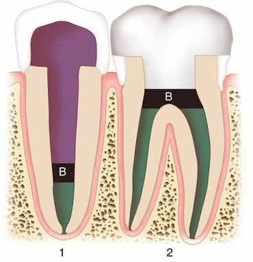 Endodontic Considerations for the Restoration of Endodontically Treated ...