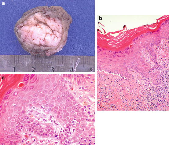 Diseases of the Vulva and Anal Neoplasia | SpringerLink