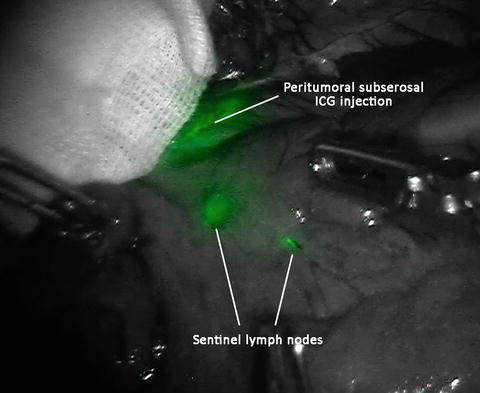 Robotic Surgery Using Firefly System | SpringerLink