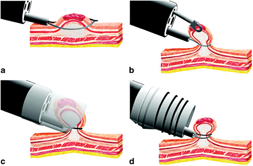 Endoscopic Resection for Gastric Cancer | SpringerLink