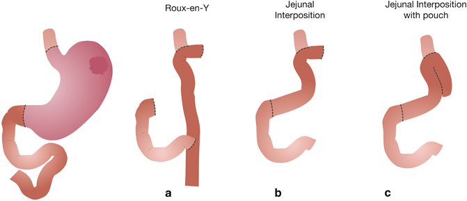Methods of Reconstruction—BI, BII, Roux-en-Y, Jejunal Interposition ...