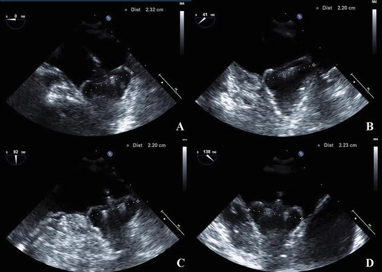 WATCHMAN Device | SpringerLink