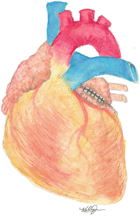 Conventional Surgery for LAA Closure | SpringerLink