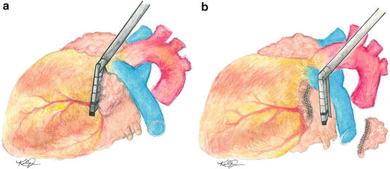 Conventional Surgery for LAA Closure | SpringerLink