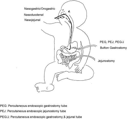 Enteral Nutrition | SpringerLink