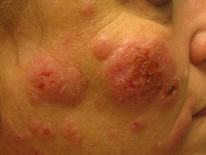 CD30+ Primary Cutaneous Anaplastic Large Cell Lymphoma | SpringerLink