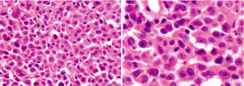 CD30+ Primary Cutaneous Anaplastic Large Cell Lymphoma | SpringerLink