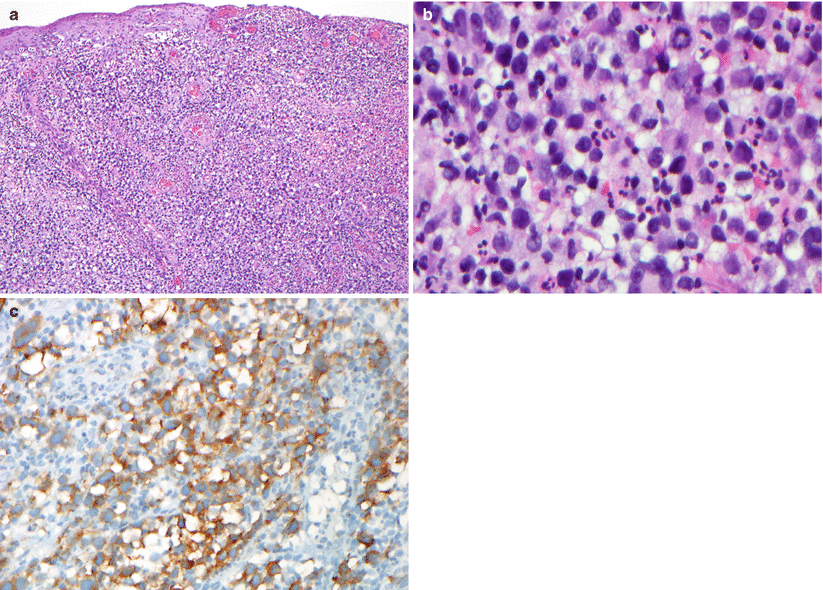 CD30+ Primary Cutaneous Anaplastic Large Cell Lymphoma | SpringerLink