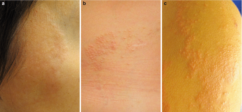 Mycosis Fungoides | SpringerLink