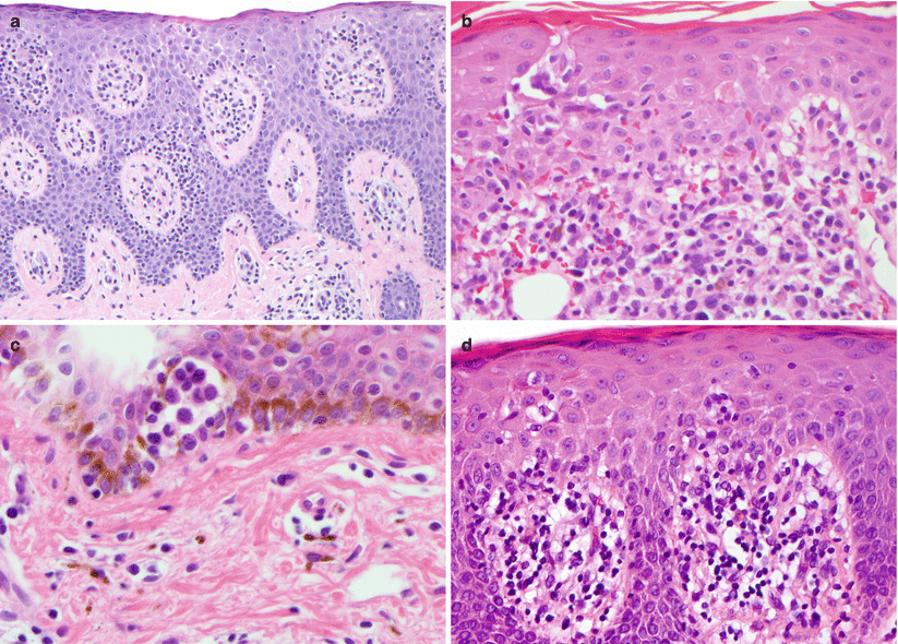 Mycosis Fungoides | SpringerLink
