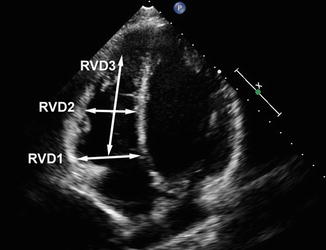 Echocardiographic Assessment of the Right Ventricle | SpringerLink