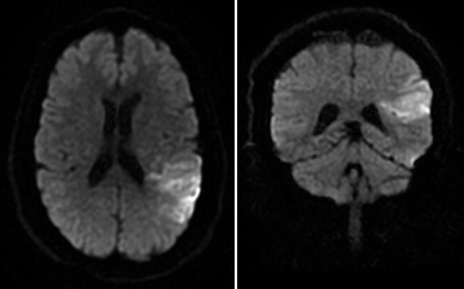 Secondary Prevention After Cardioembolic Stroke | SpringerLink