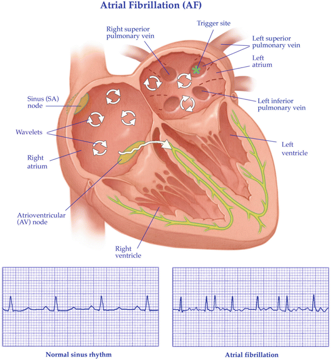 Secondary Prevention After Cardioembolic Stroke | SpringerLink