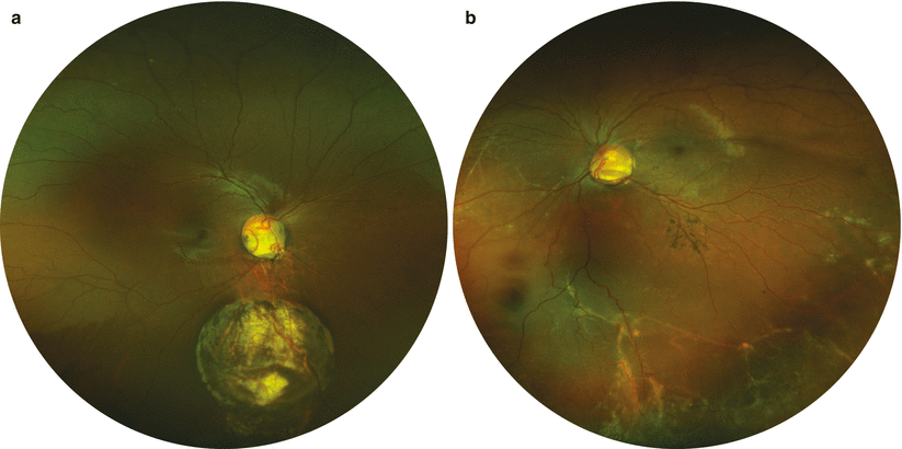 Wide-Field Imaging of the Pediatric Retina | SpringerLink