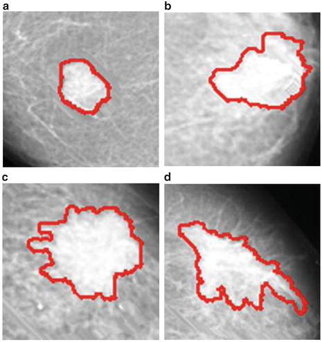Mammographic Mass Description for Breast Cancer Recognition | SpringerLink