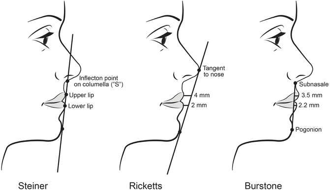 Genioplasty | SpringerLink