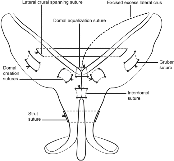 Rhinoplasty | SpringerLink