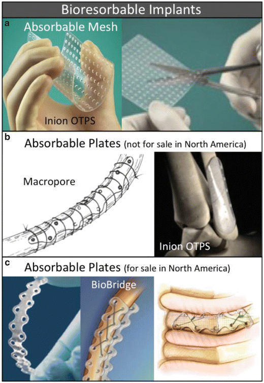 Biomechanics of Rib Fracture Fixation | SpringerLink