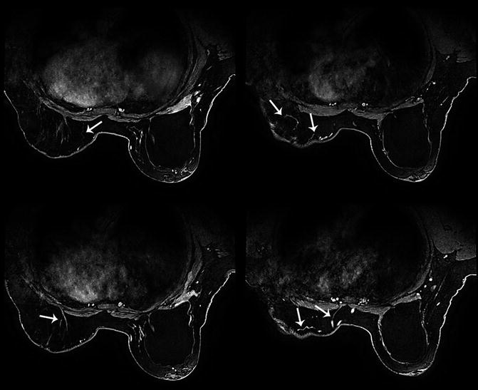 Breast Reconstruction After Radiotherapy Using Lipofilling Only ...