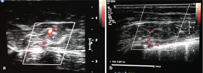 Breast Reconstruction with Deep Inferior Epigastric Perforator (DIEP ...