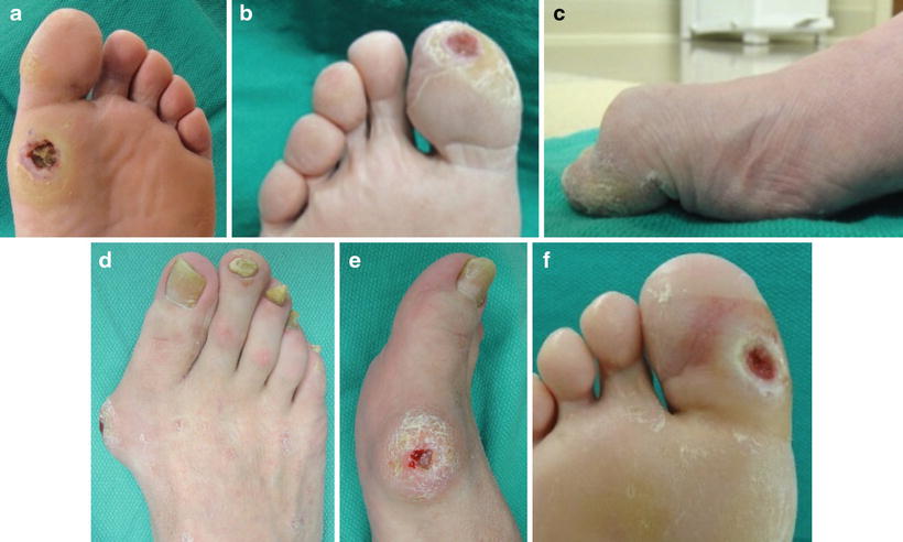 First Ray Osteomyelitis | SpringerLink