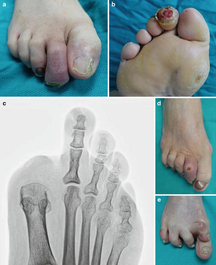 Osteomyelitis of the Central Toes | SpringerLink