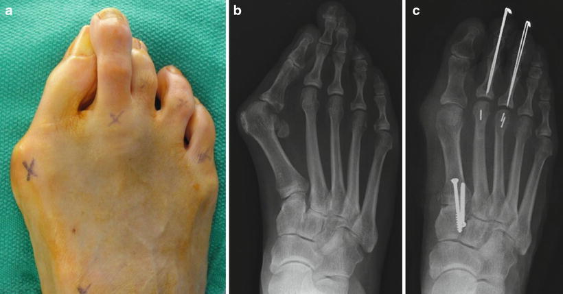 Osteomyelitis of the Central Toes | SpringerLink