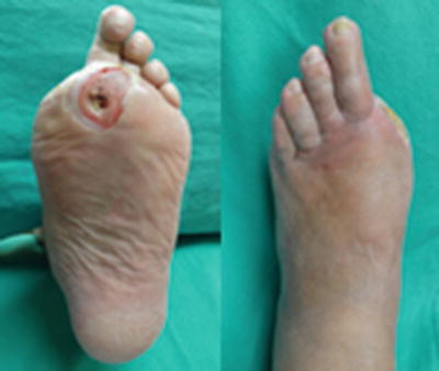 Transmetatarsal and Lisfranc Amputation | SpringerLink