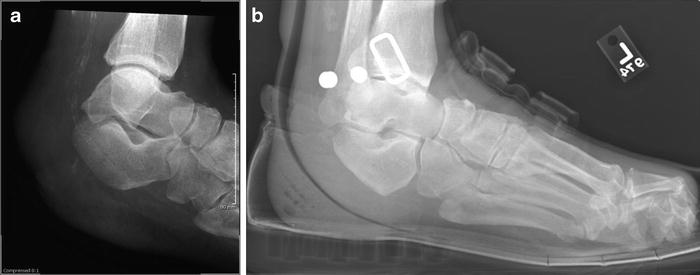 Osteomyelitis of the Calcaneus | SpringerLink