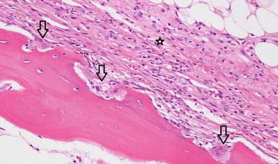 Pathologic Diagnosis of Osteomyelitis | SpringerLink