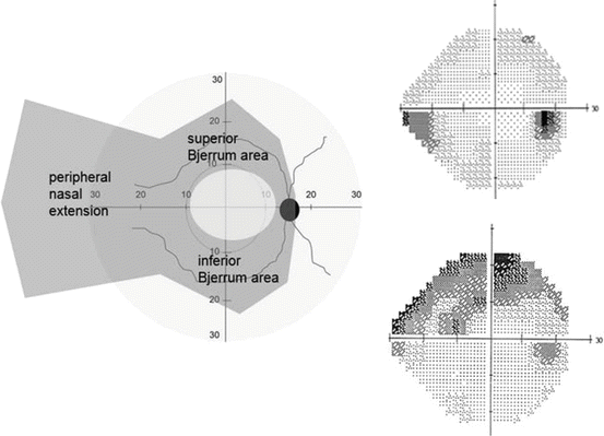 Standard Automated Perimetry | SpringerLink
