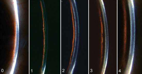 Gonioscopy | SpringerLink