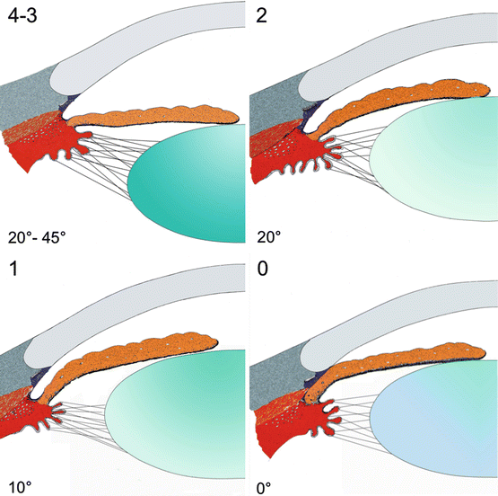 Gonioscopy | SpringerLink