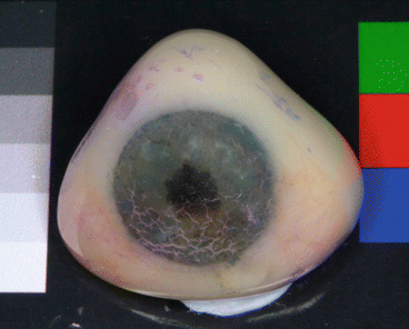 Mucoid Discharge Associated with Prosthetic Eye Wear | SpringerLink