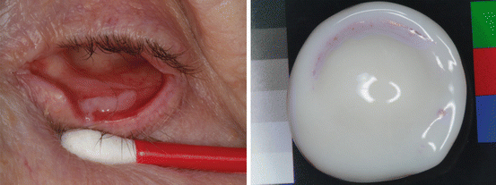 Mucoid Discharge Associated with Prosthetic Eye Wear | SpringerLink