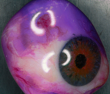 Mucoid Discharge Associated with Prosthetic Eye Wear | SpringerLink