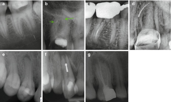 Separated Endodontic Instruments | SpringerLink