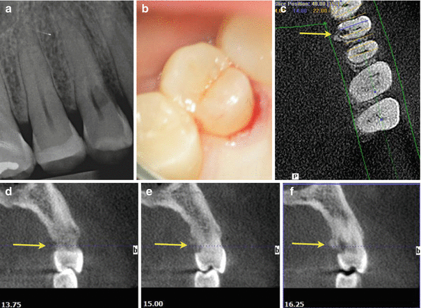 Root Resorption | SpringerLink