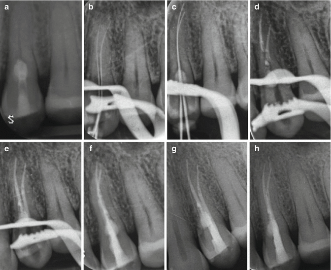 Root Resorption | SpringerLink